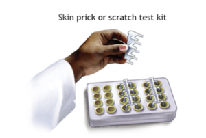 Diagnostic Approach to Allergies: Skin Prick Test – Noah Therapeutics