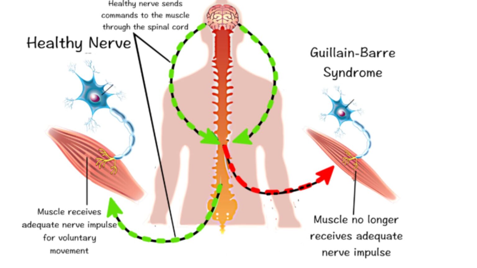 Guillain-Barré Syndrome (GBS) on the Rise: Here is What You Need to ...
